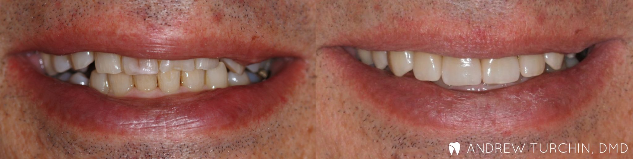 Dentist Aspen CO | Andrew Turchin | Before & After Gallery